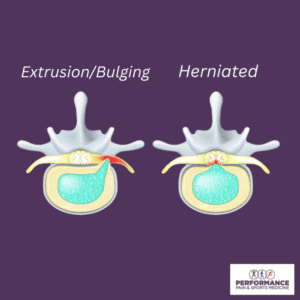 Difference Between Disc Herniation and Disc Extrusion - Performance ...